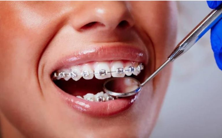 Improve Your Smile: Everything You Need to Know About Metal Braces ...